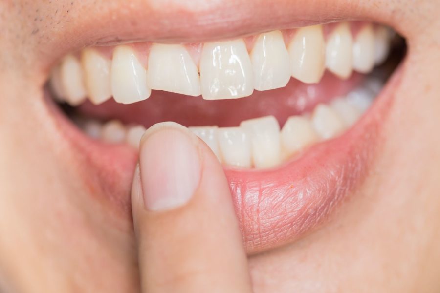 How To Fix A Chipped Tooth Dentist In Marietta Ga